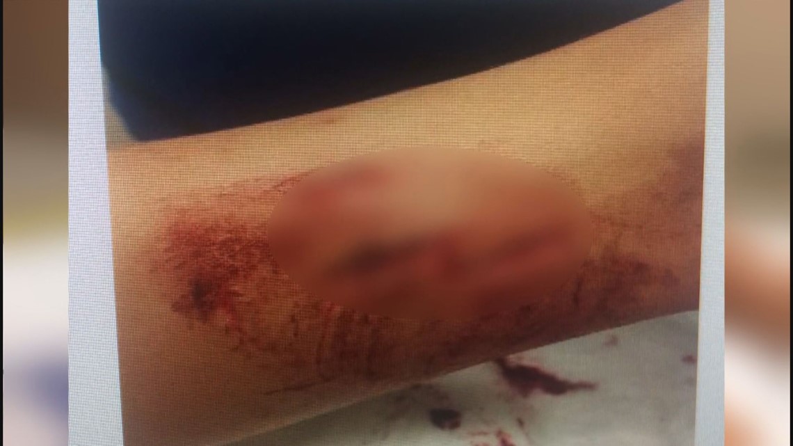 Fish chews on 11-year-old girl's foot, causes bone-deep cuts | 11alive.com