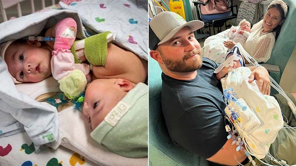 Conjoined twins in Houston head home after being separated | 11alive.com