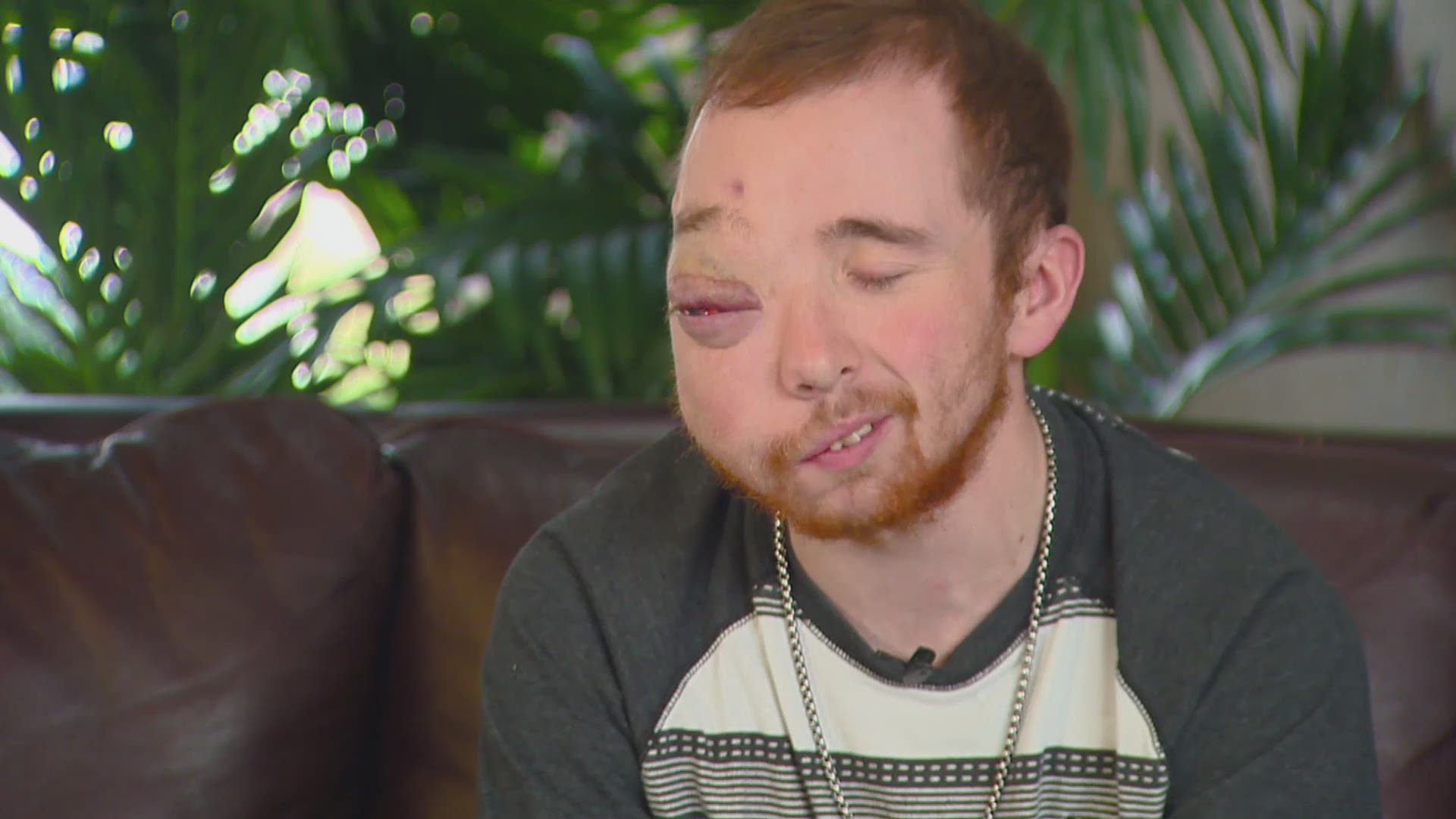 Lucas McCulley's post-surgery look revealed: 'It feels like I have got ...