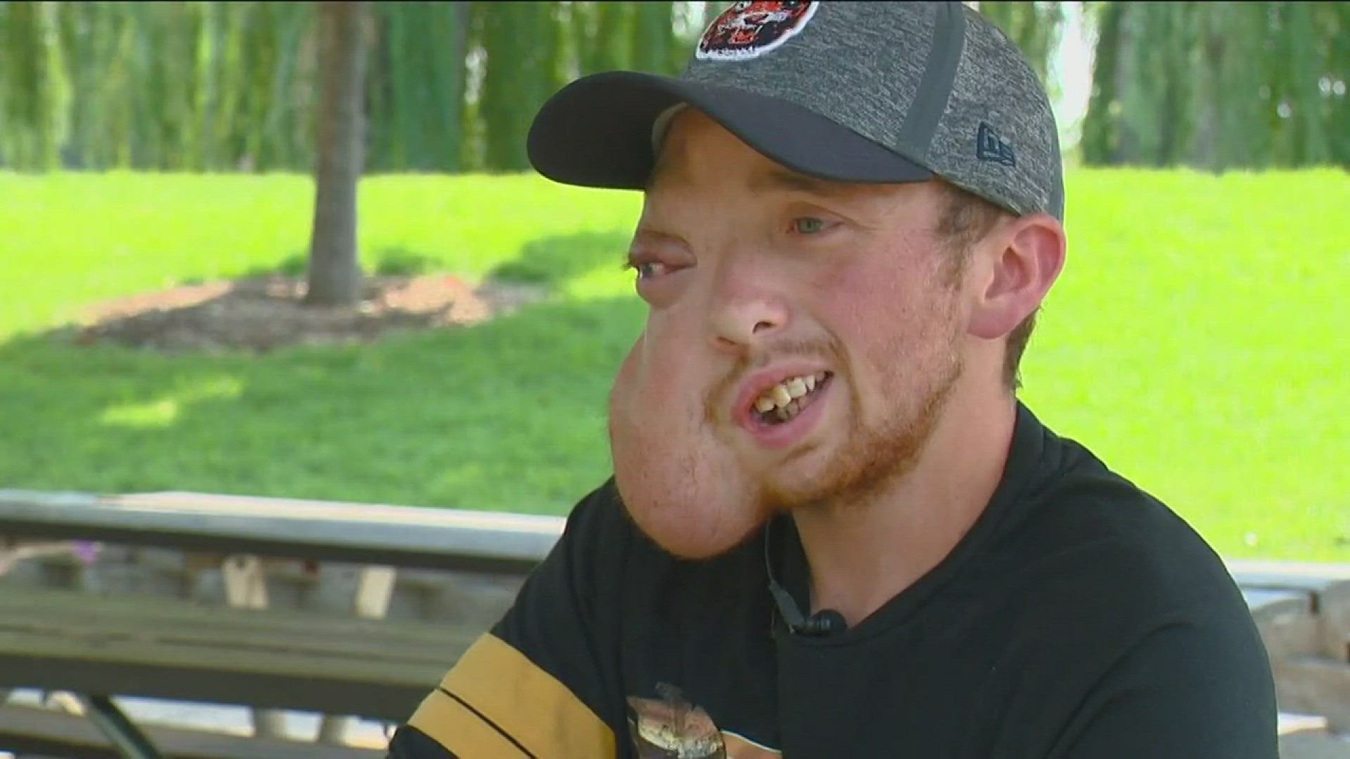 Man with tumor on his face seeking community's help | 11alive.com
