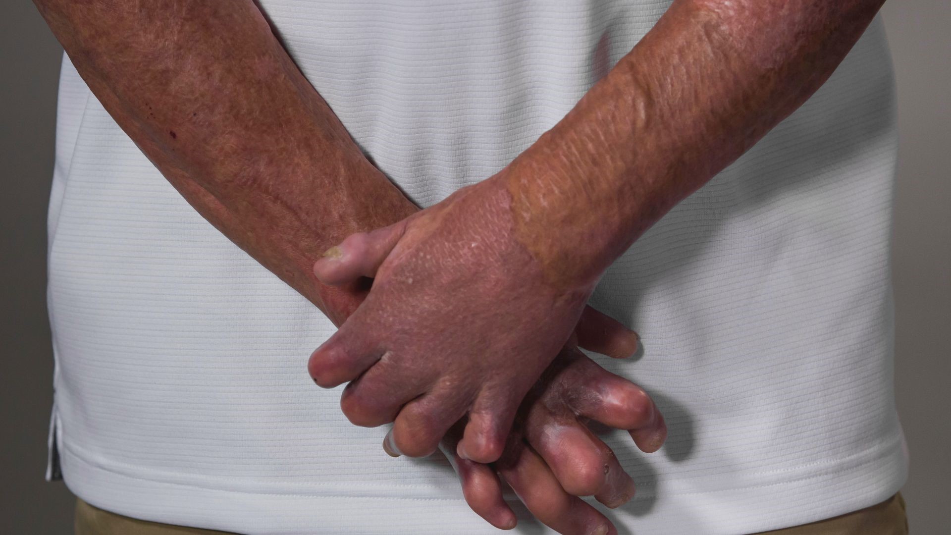 Man makes miraculous recovery after preventable inferno burns 90 ...