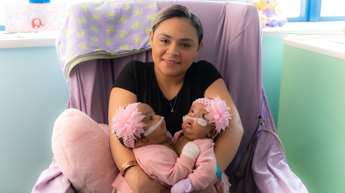 Formerly conjoined twins celebrate one year post-op | 11alive.com