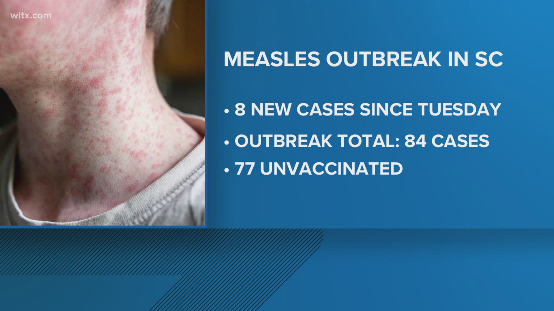 DPH reports eight new measles cases as outbreaks in South Carolina ...