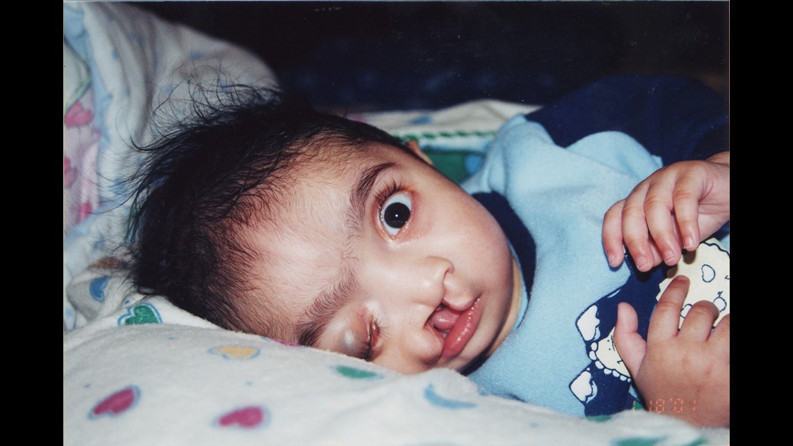 Group fights human trafficking with surgeries for facial deformities ...