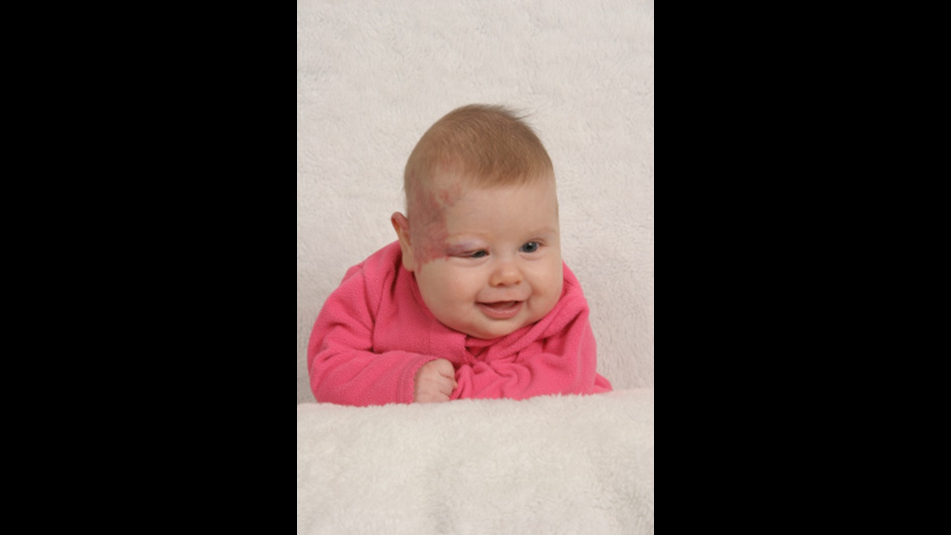 Dunwoody girl gives face to PHACE Syndrome | 11alive.com