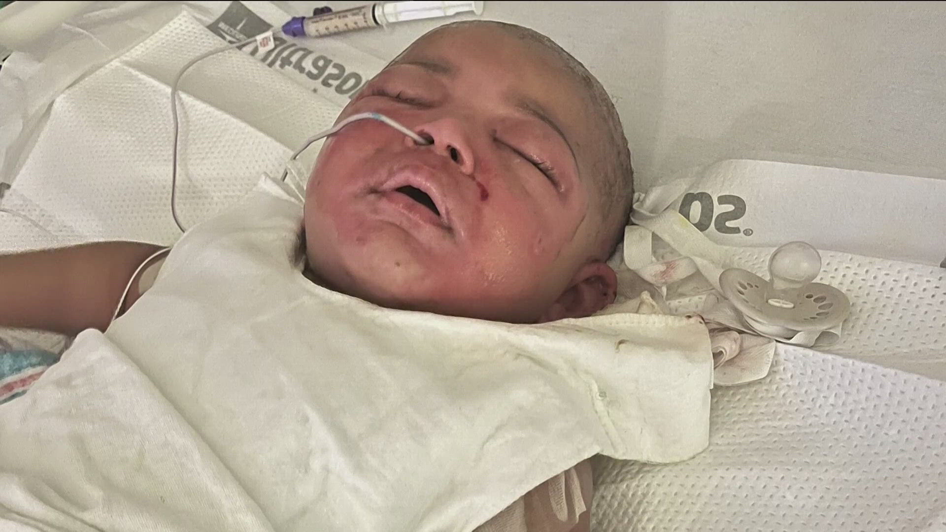 11-month-old gets rare skin infection, parents share story | 11alive.com