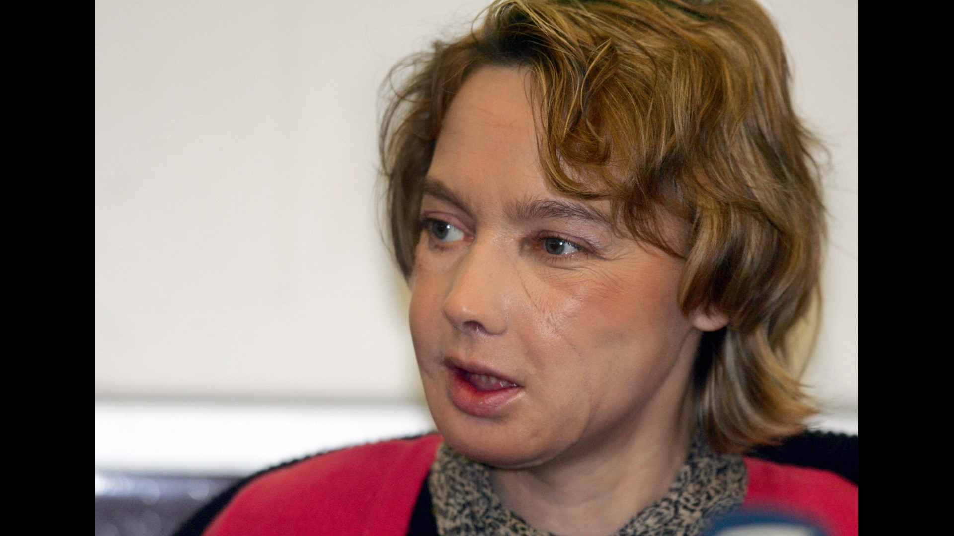 World's 1st face transplant recipient dies at 49 | 11alive.com