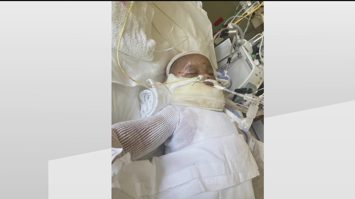 Georgia baby severely burned in freak accident, family struggling ...