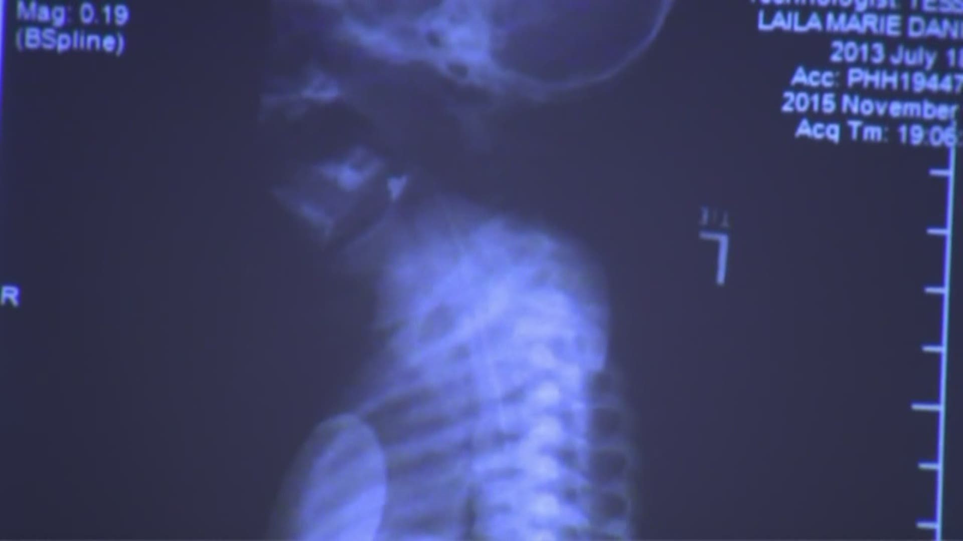 Rosenbaum trial: Doctor talks about Laila Daniel x-rays | 11alive.com