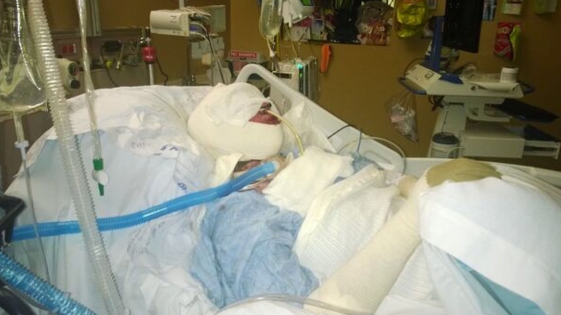 Woman's skin 'melts off' after medication error | 11alive.com