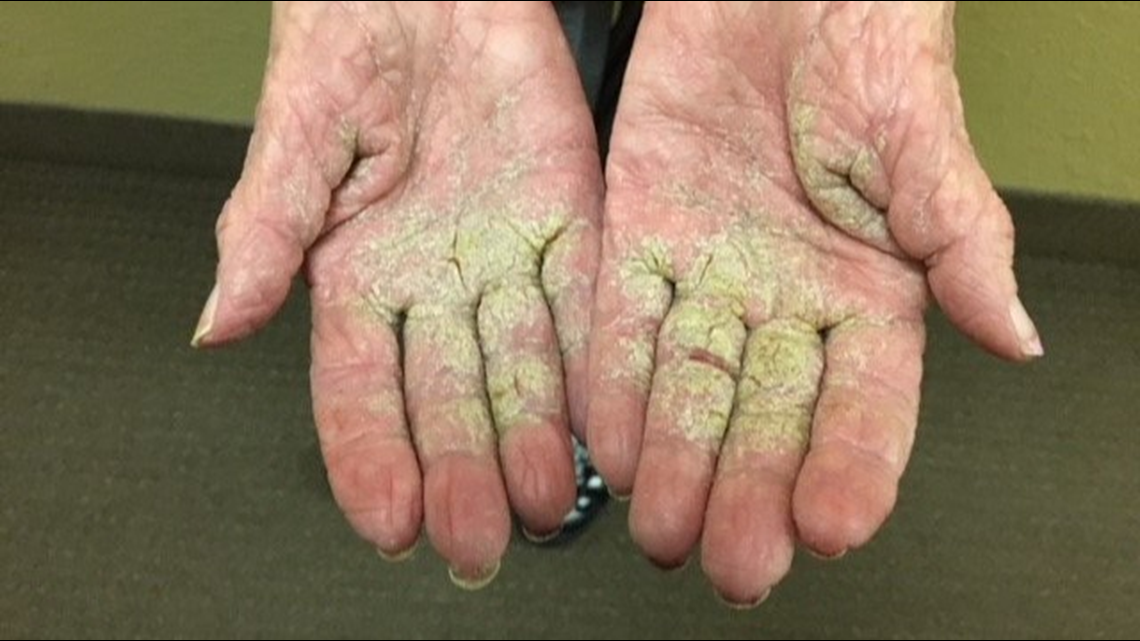 'Worst case she'd ever seen' | Another nursing home resident eaten ...