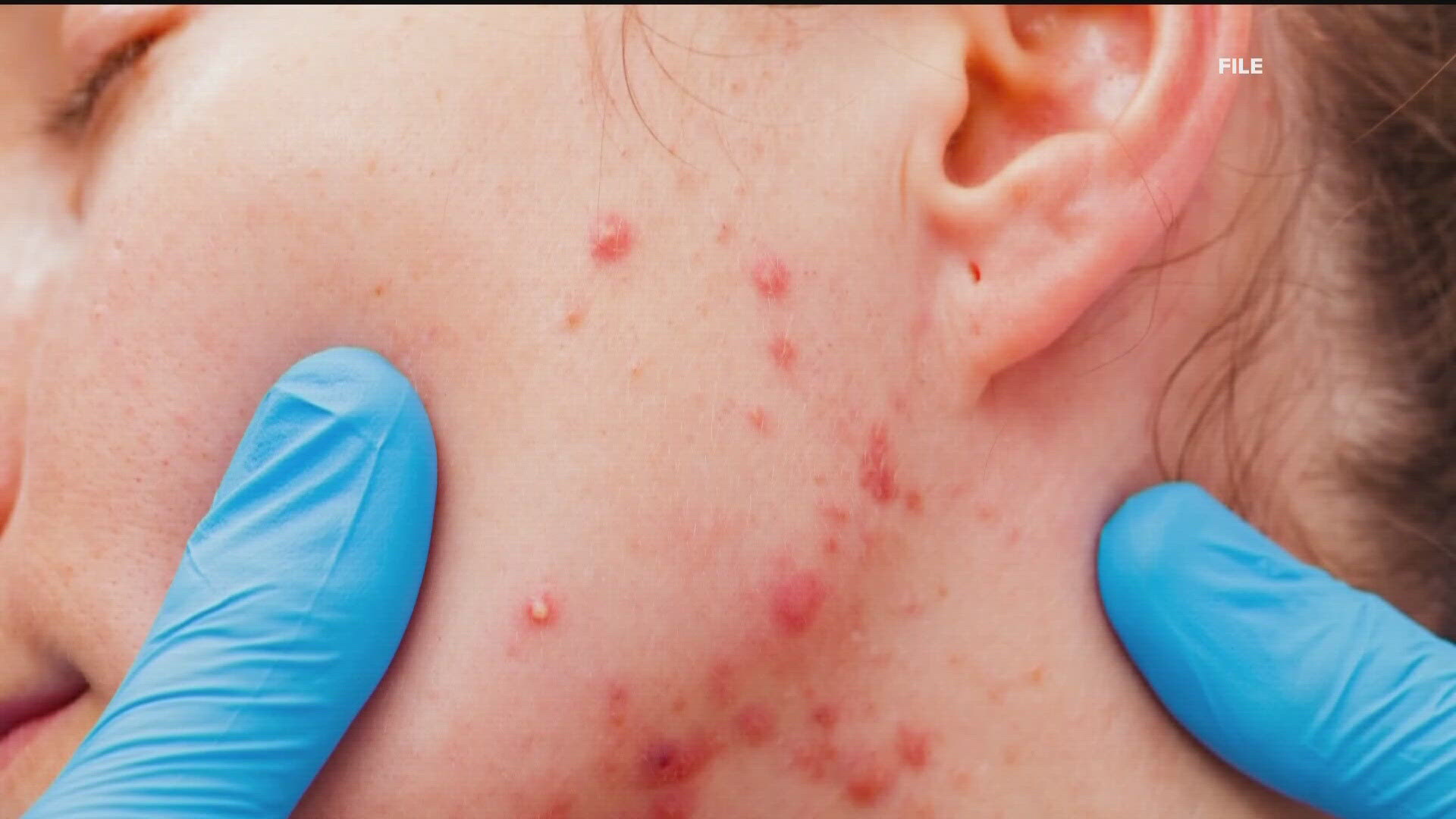 3 people in Georgia infected with measles | 11alive.com