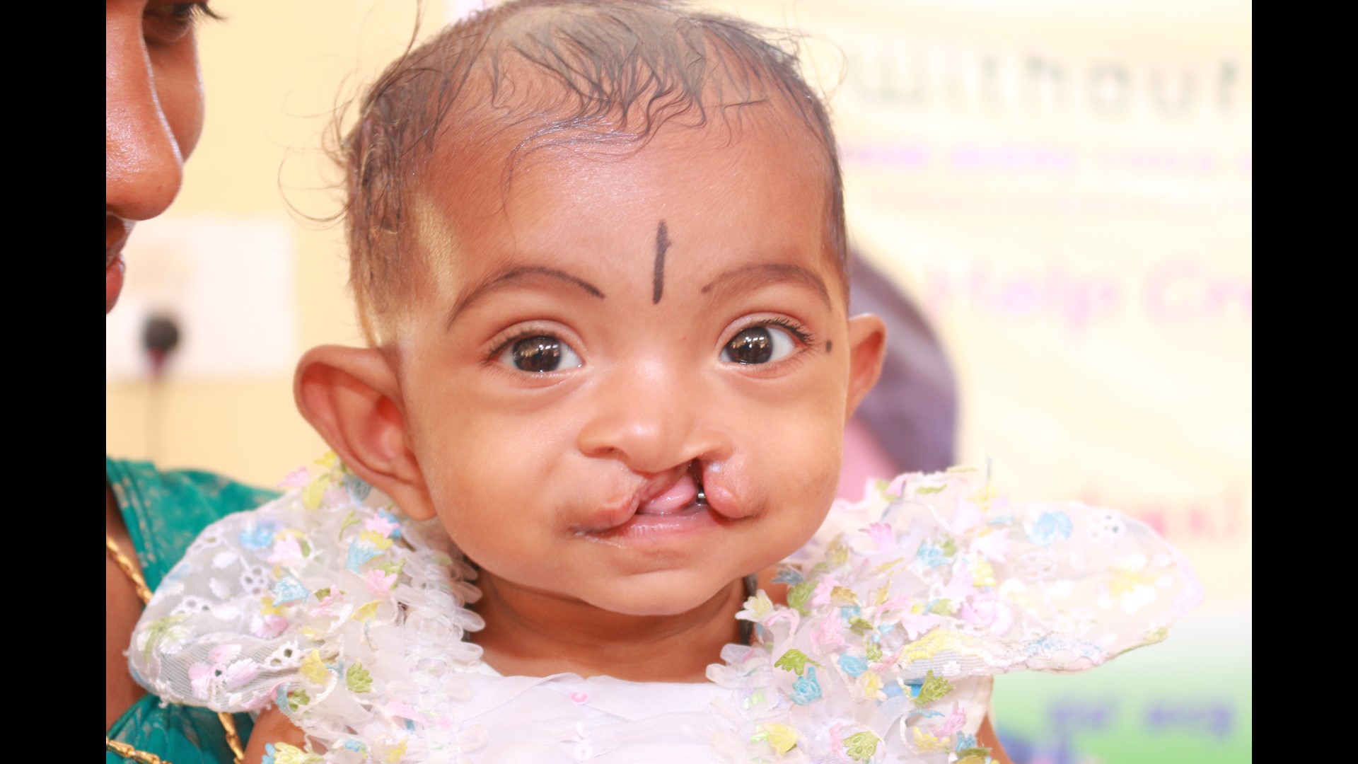 Group fights human trafficking with surgeries for facial deformities ...
