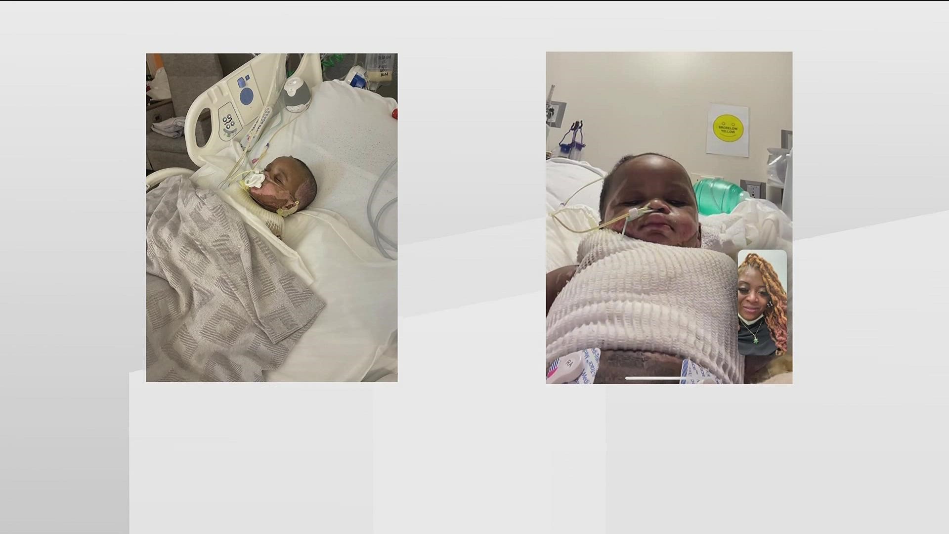 Georgia baby taken off sedation after suffering burns on 40% of his ...