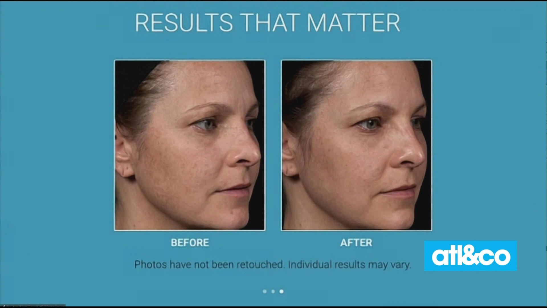 Spring Skincare with Solta Medical | 11alive.com