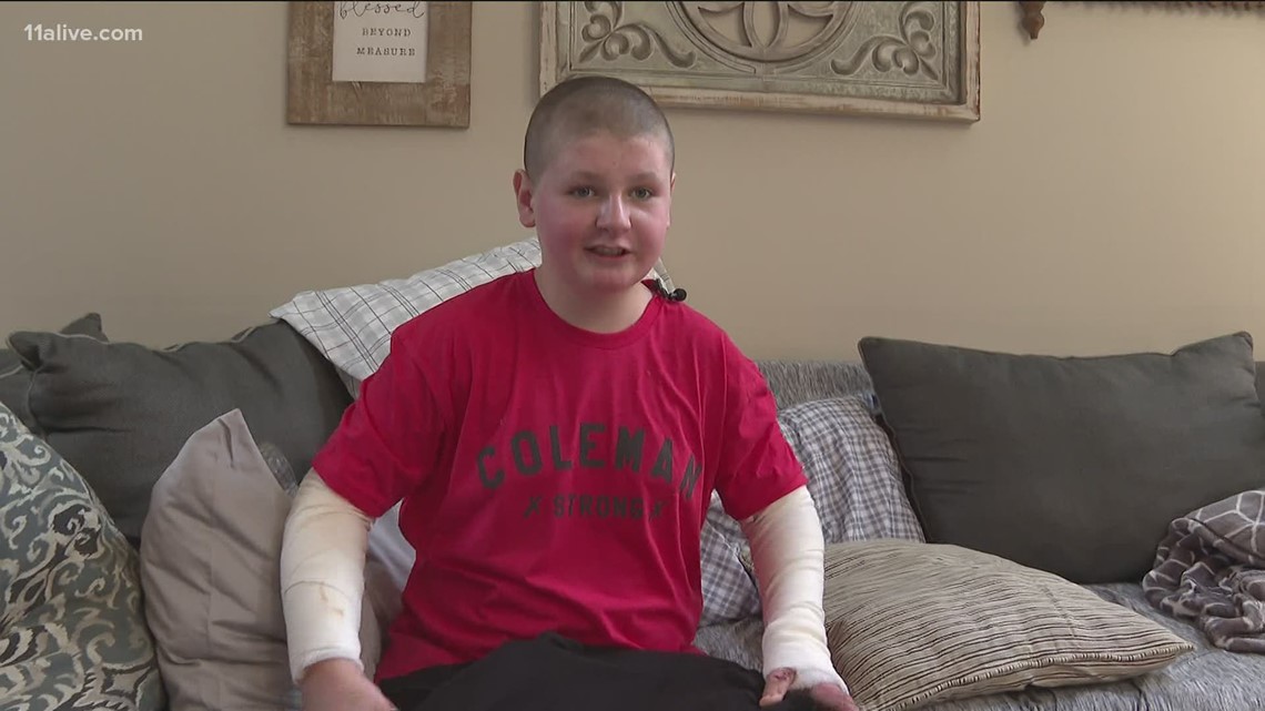 Lake Lanier boat explosion victim Gunner Coleman back home | 11alive.com