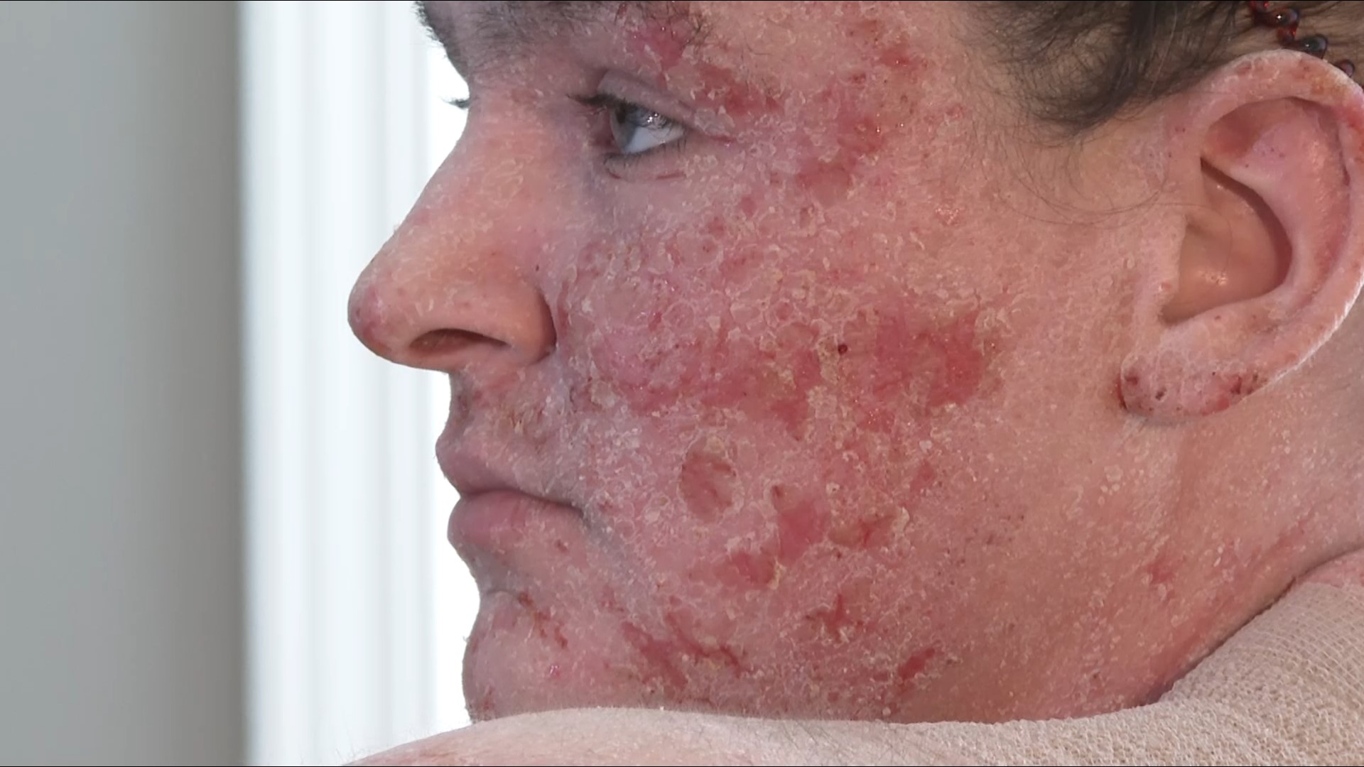 Georgia woman claims using steroid creams led to chronic pain | 11alive.com