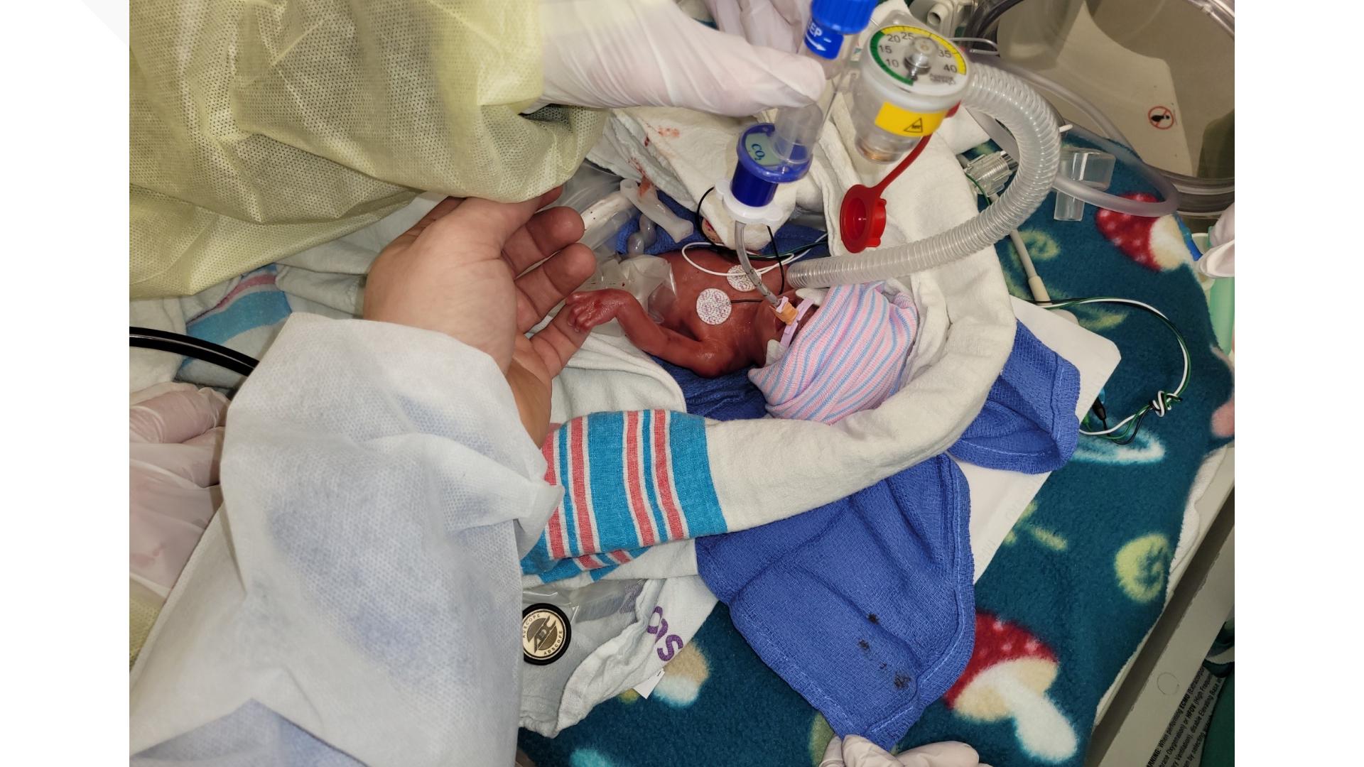 Georgia toddler defies odds, born at 22 weeks in NICU | 11alive.com