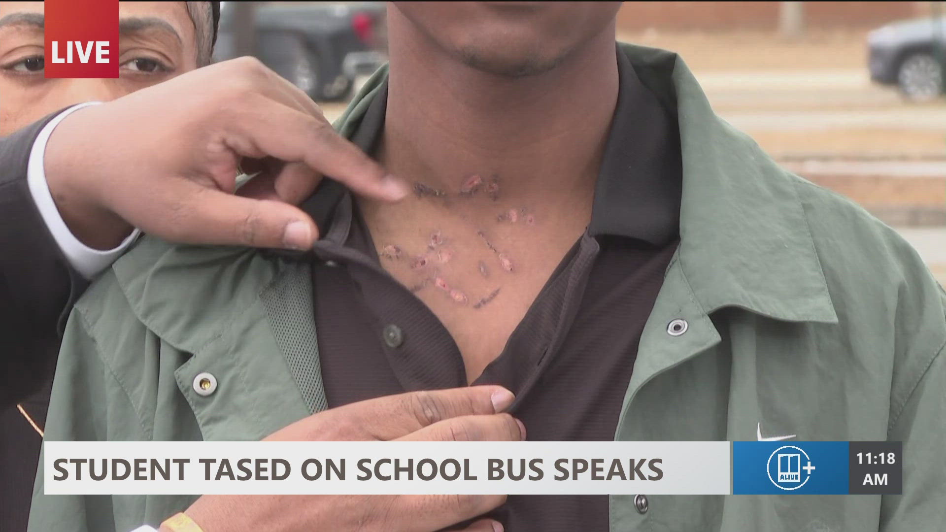 Attorney Daniels shows burn marks on teens throat, chest from ...