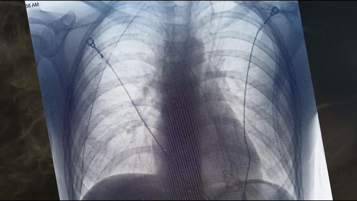Georgia teenager hospitalized with collapsed lungs due to vaping ...