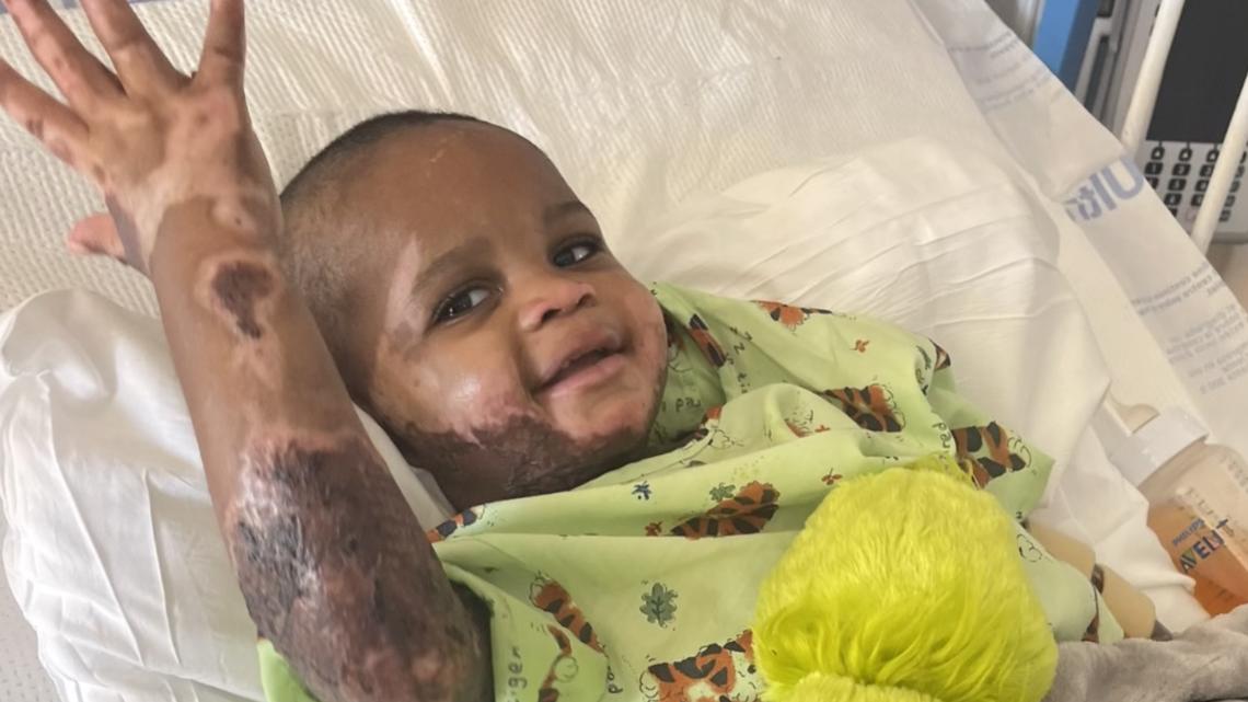 After suffering burns on 40% of body, Bubby is home | 11alive.com